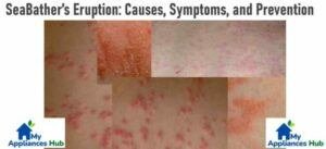 Avoiding SeaBather's Eruption: Causes, Symptoms, Treatment, and Prevention